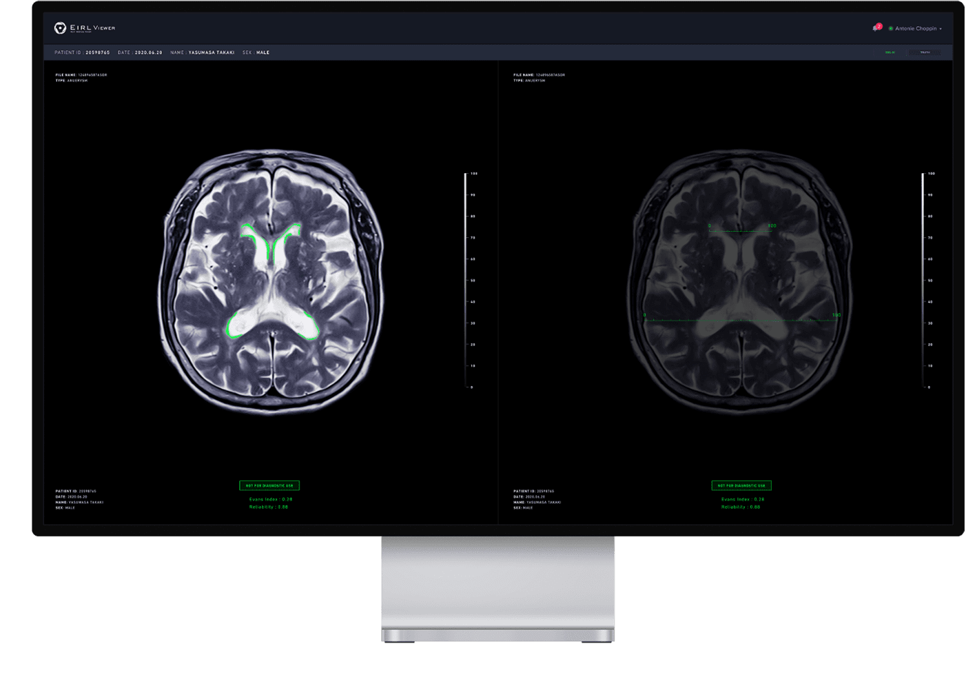 EIRL(エイル) | AI画像診断支援技術 | エルピクセル株式会社 - EIRL（エイル）は、CT, MRI, 病理画像などの医療画像を中心に多様な医療ビックデータを活用し、独自の人工知能 ...
