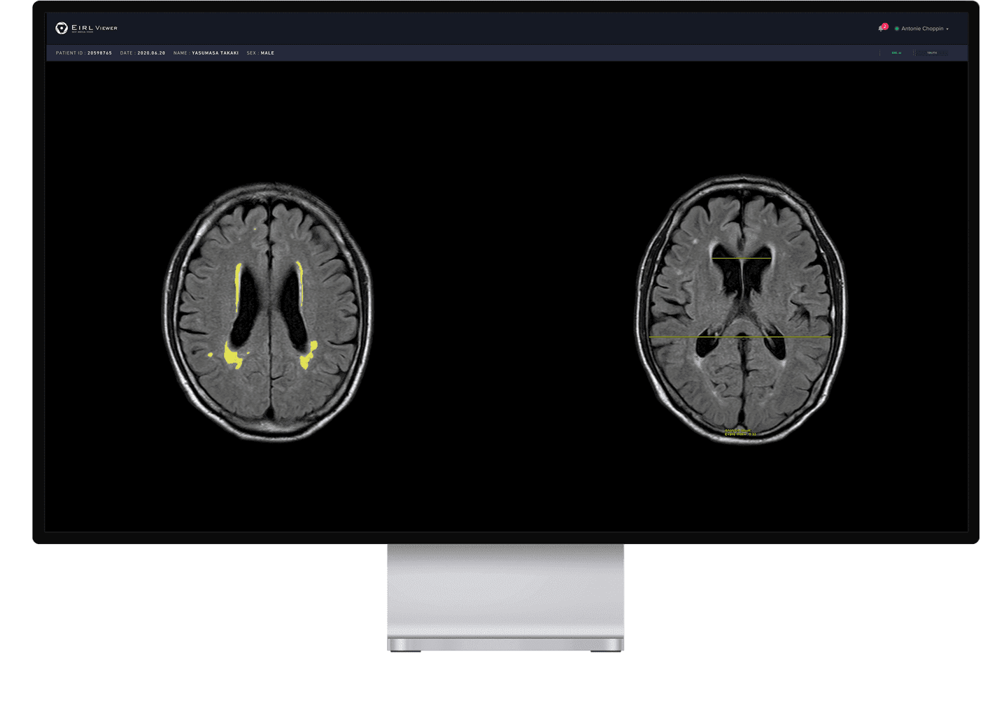 EIRL(エイル) | AI画像診断支援技術 | エルピクセル株式会社 - EIRL（エイル）は、CT, MRI, 病理画像などの医療画像を中心に多様な医療ビックデータを活用し、独自の人工知能 ...