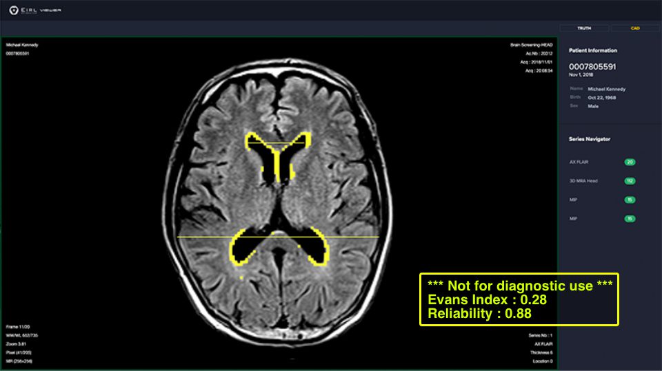 EIRL Brain Metry - EIRL(エイル) | AI画像診断支援技術 | エルピクセル株式会社
