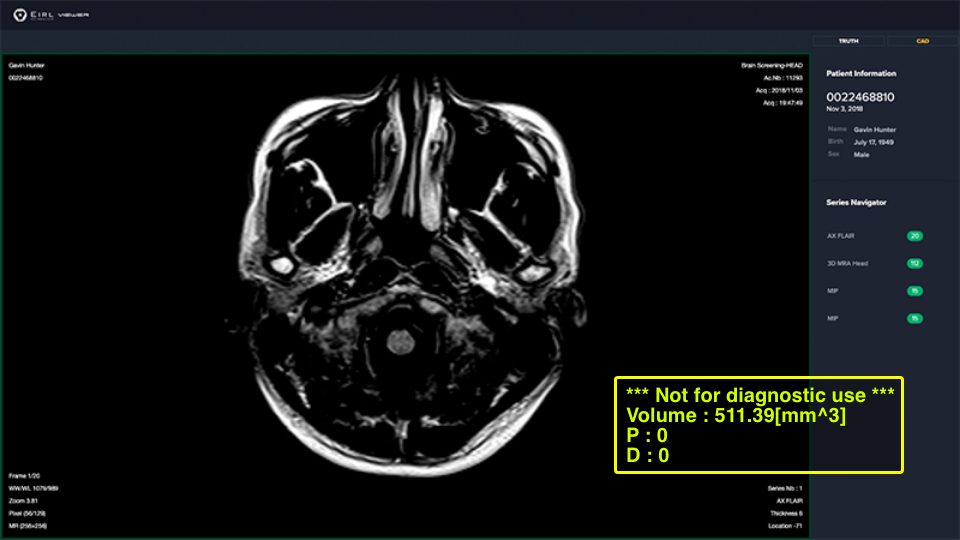 EIRL Brain Metry - EIRL(エイル) | AI画像診断支援技術 | エルピクセル株式会社