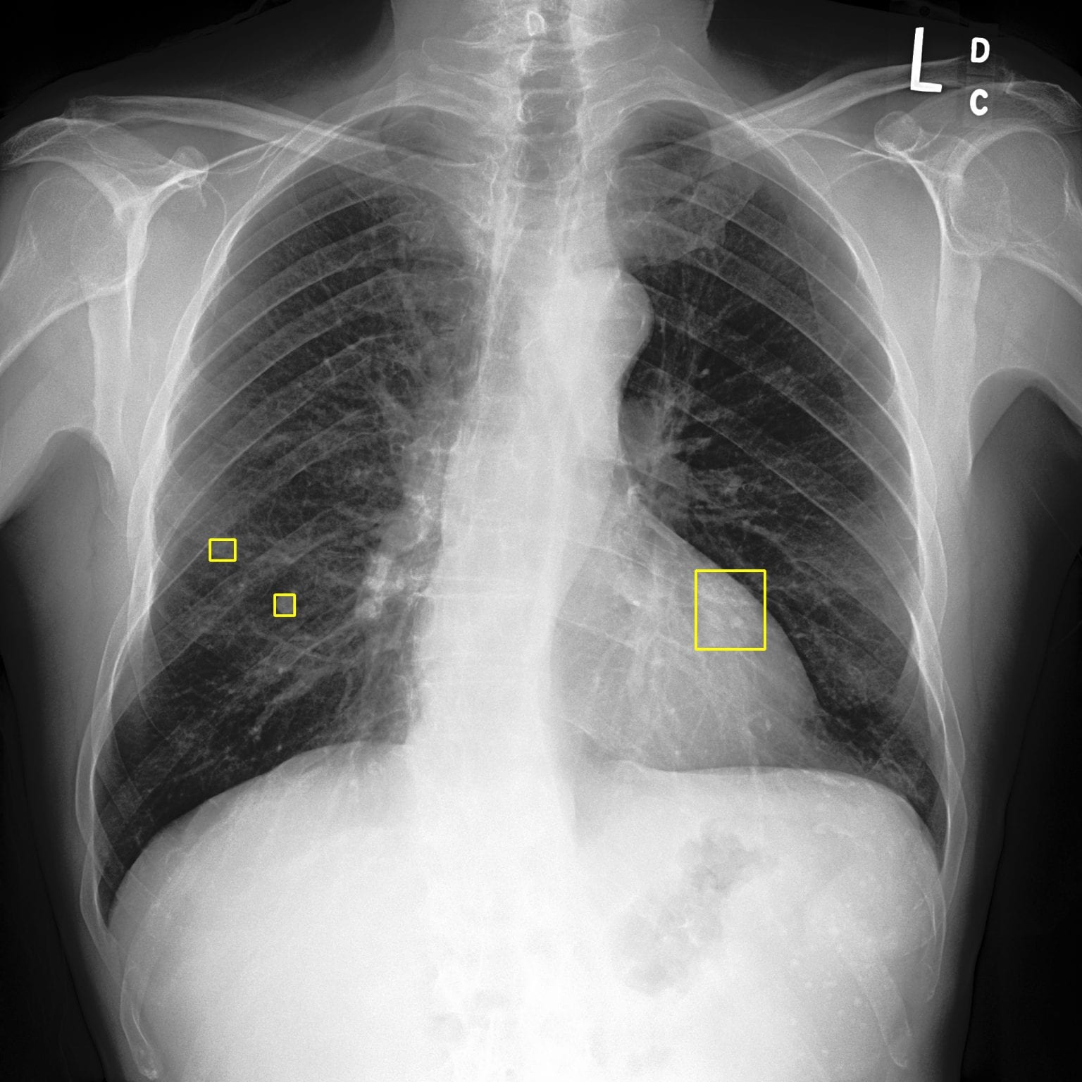 EIRL Chest Nodule - EIRL | PRODUCED BY LPIXEL | LPIXEL Inc.