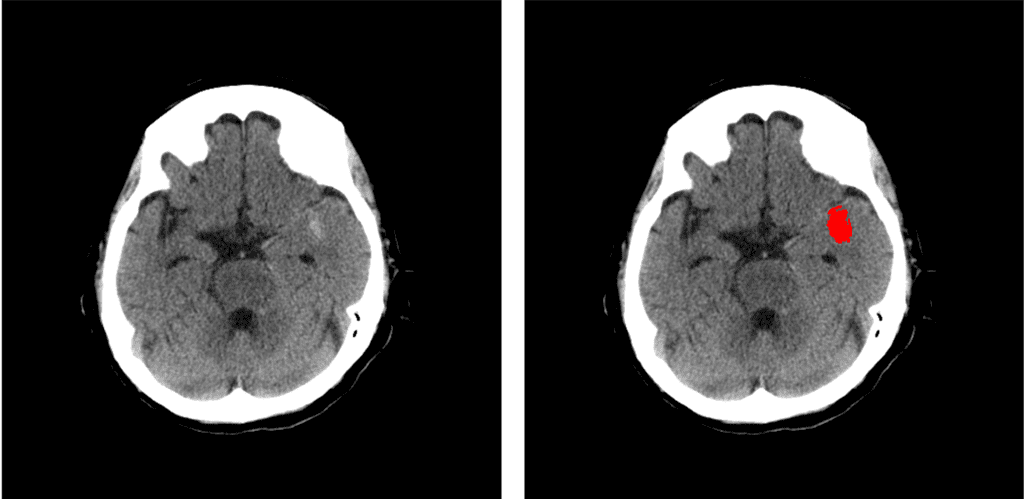 Eirl Brain Segmentation、頭部ct画像から 高吸収/低吸収領域及び組織構造・境界の不明瞭化がみられる領域の 抽出・表示が
