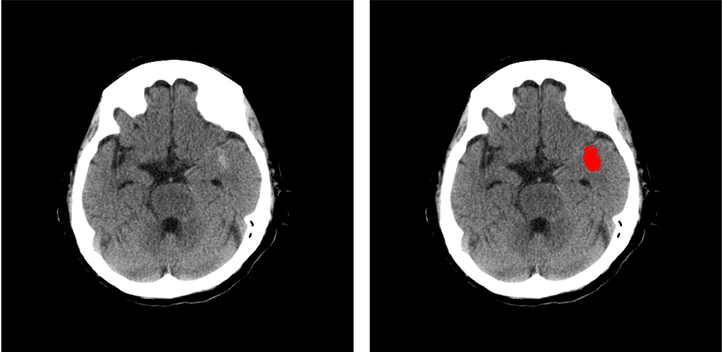 Eirl Brain Segmentation、頭部ct画像から 高吸収/低吸収領域及び組織構造・境界の不明瞭化がみられる領域の 抽出・表示が
